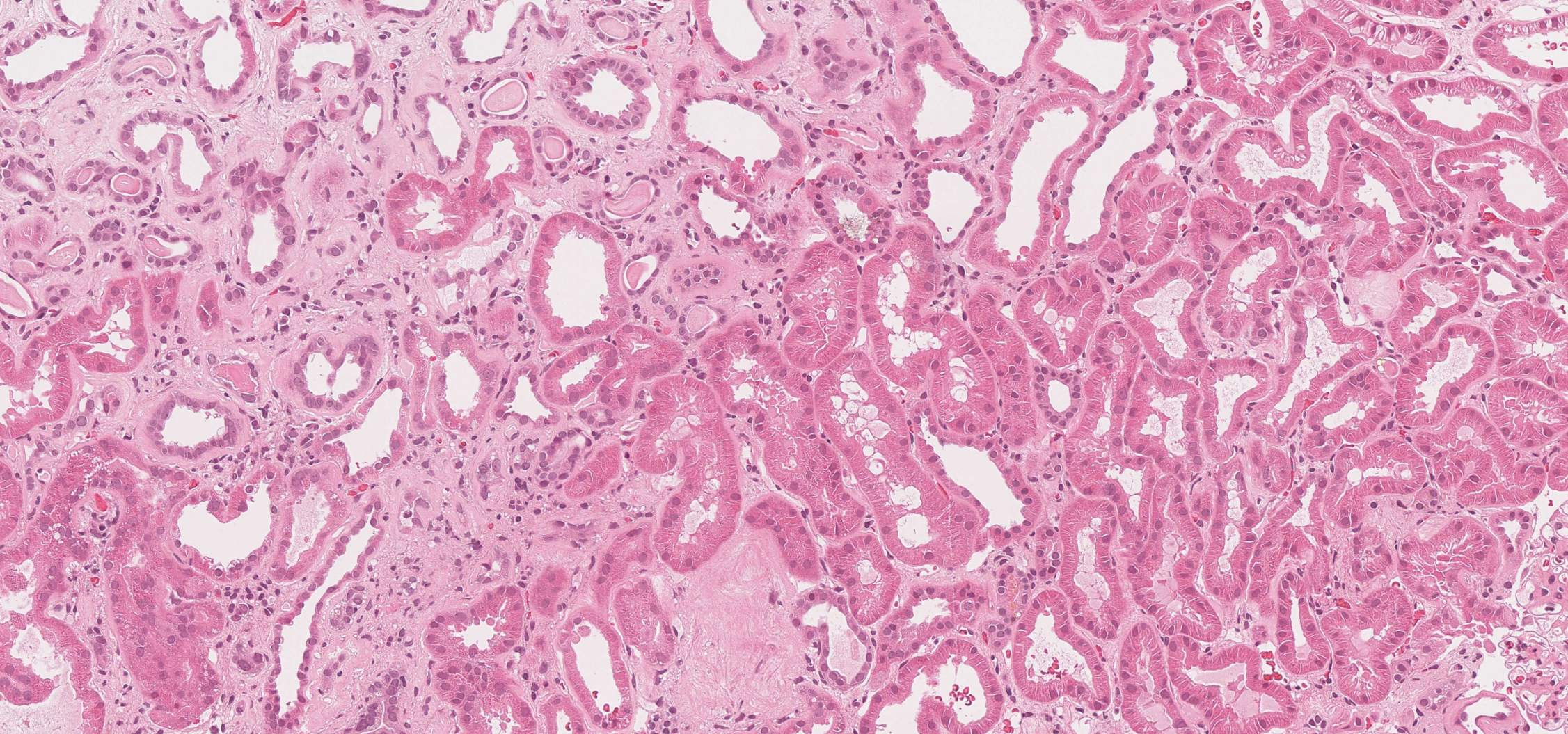 Kidney fibrosis - Helse Bergen HF